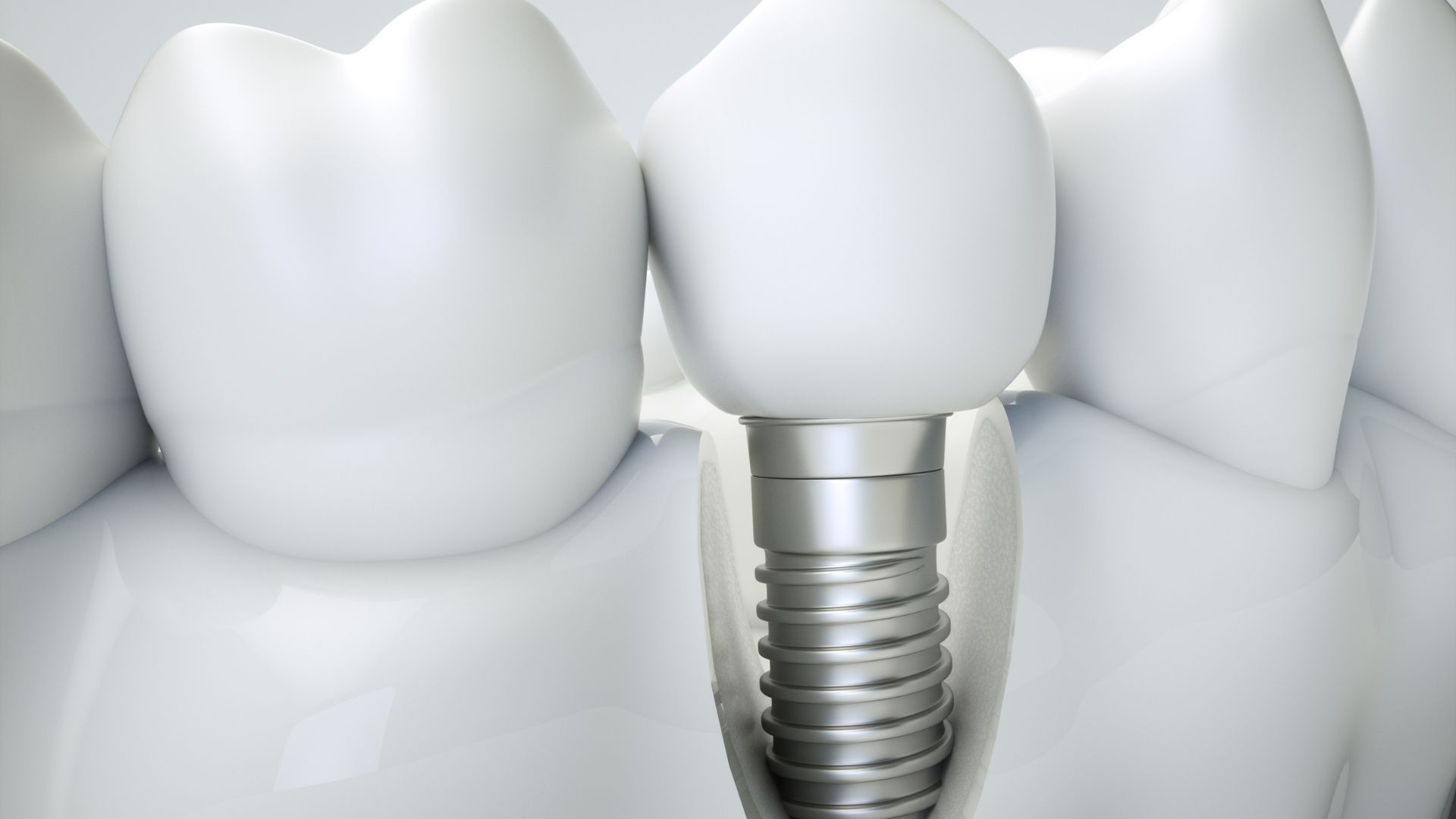 Saiba as principais vantagens de fazer um implante dentário